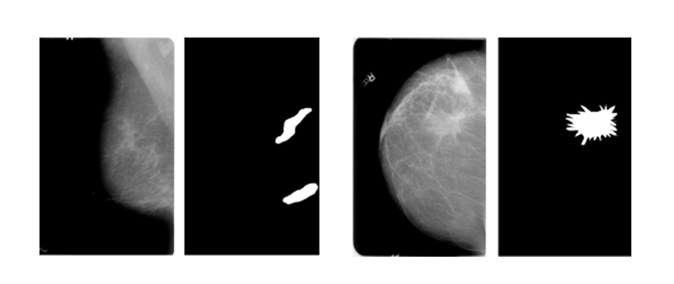 [2404.03892] Enhancing Breast Cancer Diagnosis in Mammography ...