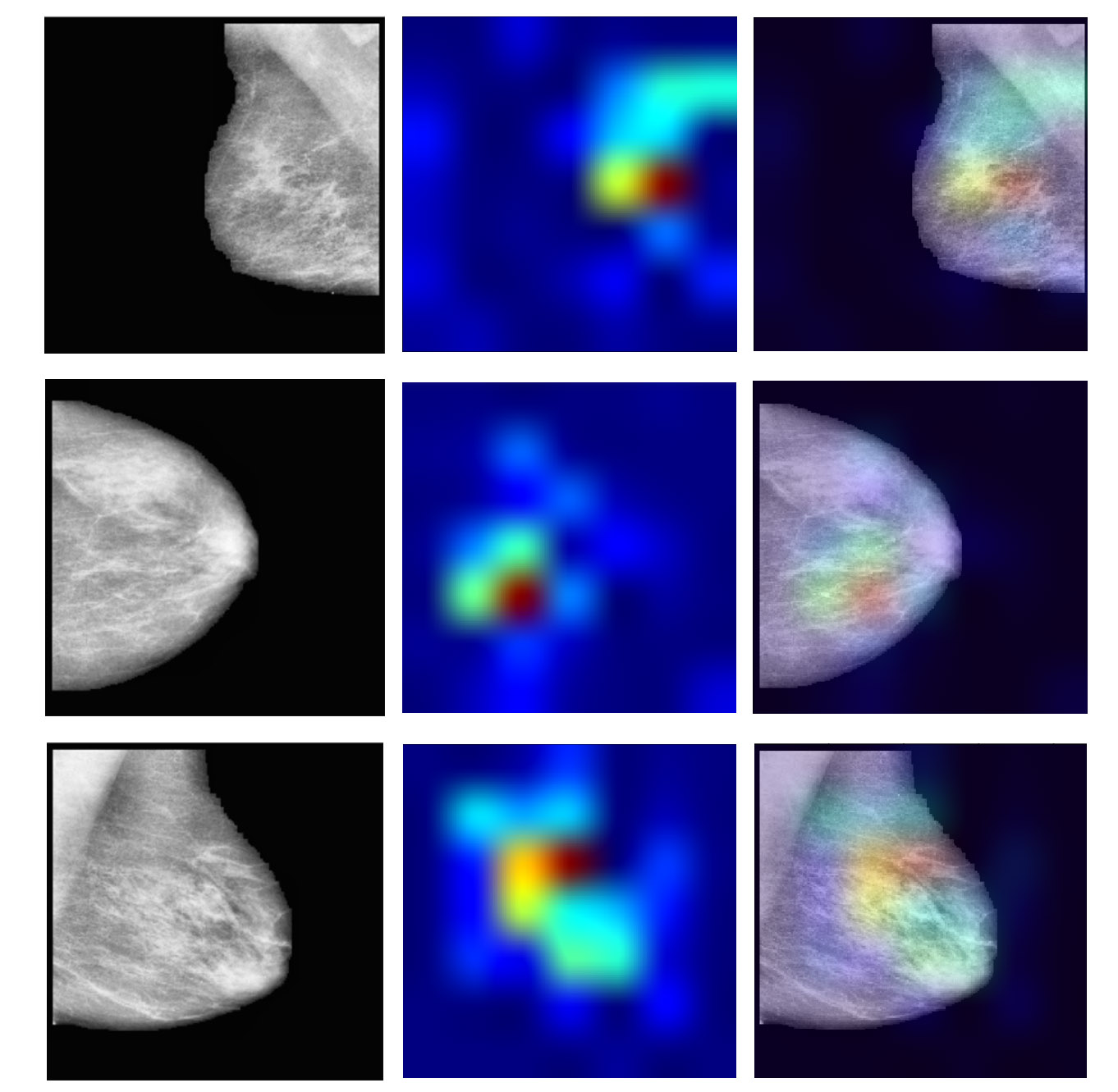 [2404.03892] Enhancing Breast Cancer Diagnosis in Mammography ...