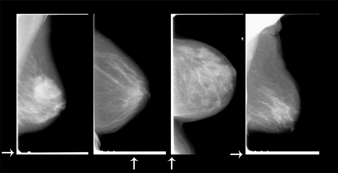 [2404.03892] Enhancing Breast Cancer Diagnosis in Mammography ...