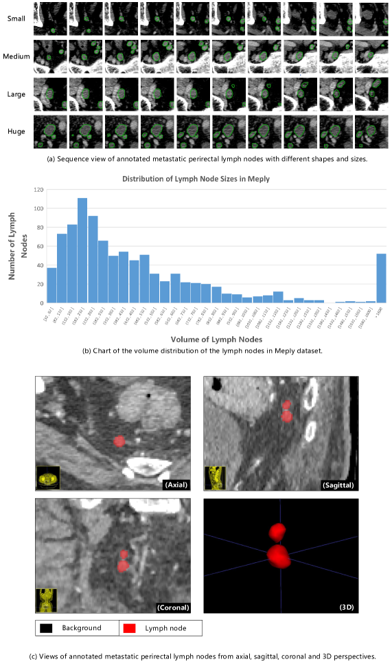 [2404.08916] Meply: A Large-scale Dataset and Baseline Evaluations for Metastatic Perirectal ...
