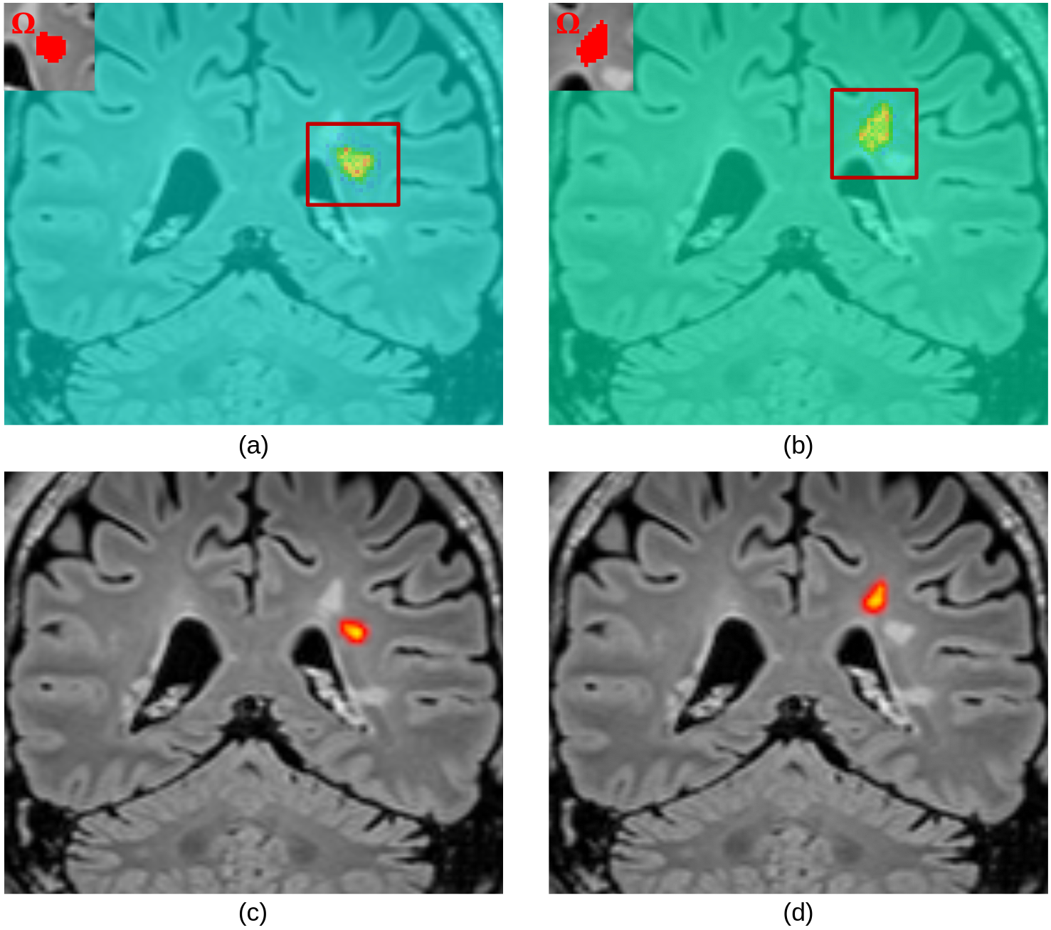 [2406.09335] Instance-level quantitative saliency in multiple sclerosis lesion segmentation