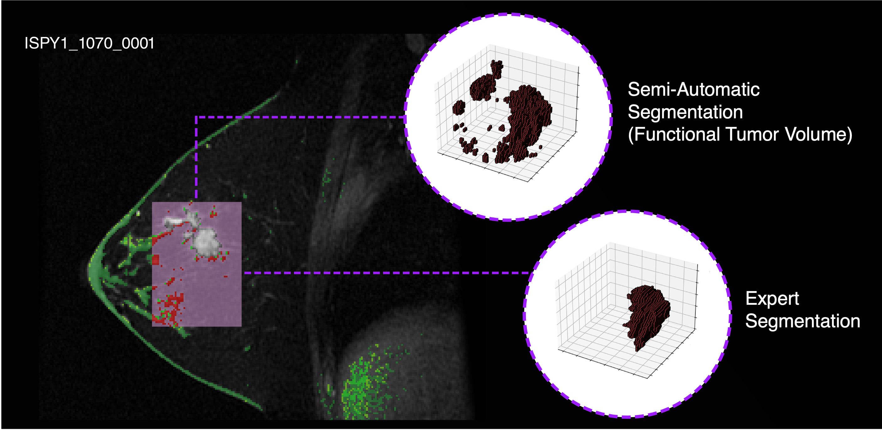 [2406.13844] MAMA-MIA: A Large-Scale Multi-Center Breast Cancer DCE-MRI ...