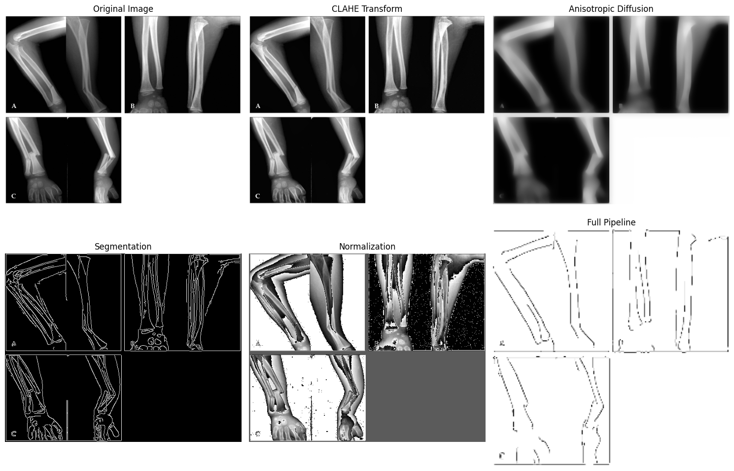 [2406.15958] Bone Fracture Classification Using Transfer Learning