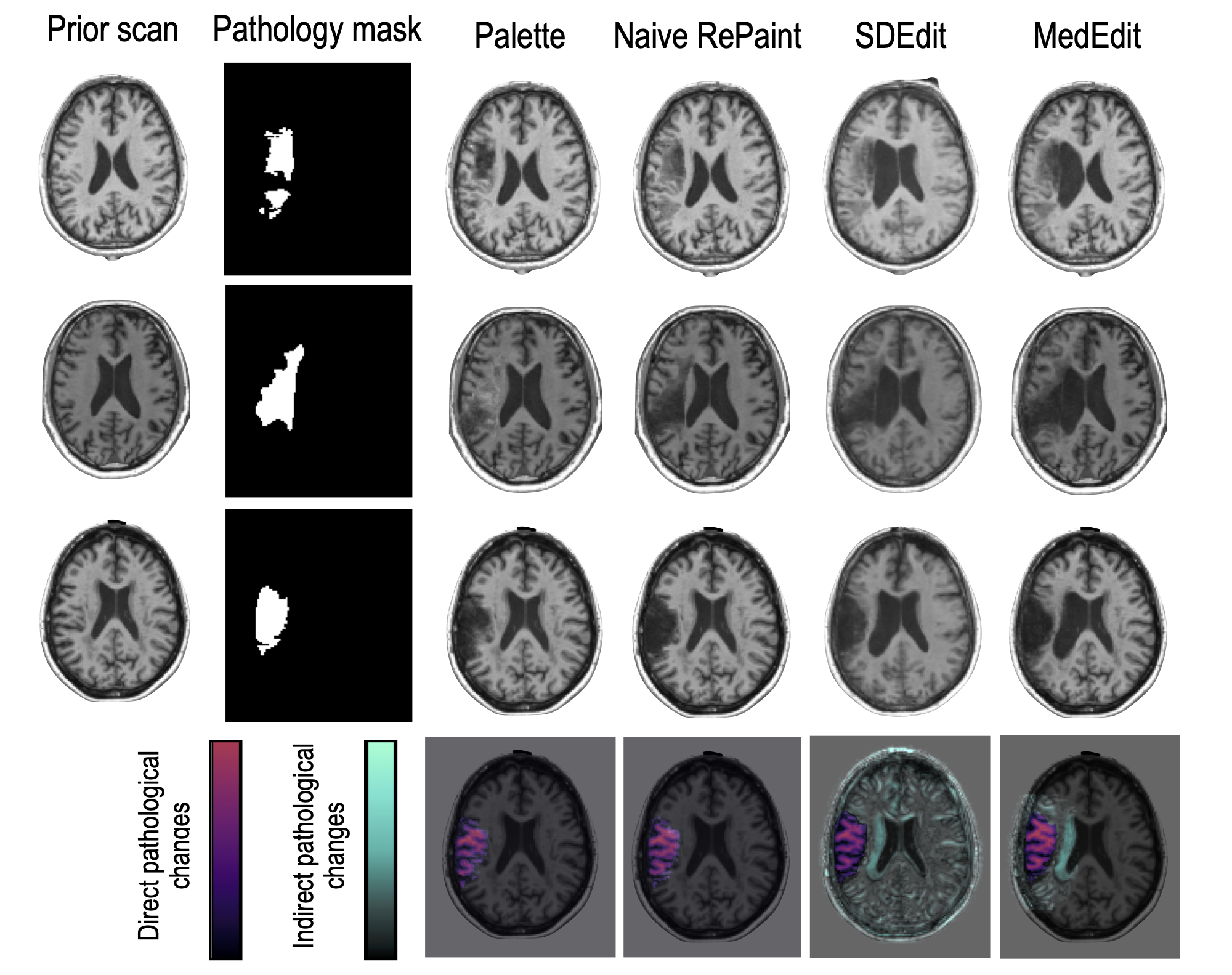 [2407.15270] MedEdit: Counterfactual Diffusion-based Image Editing on Brain MRI