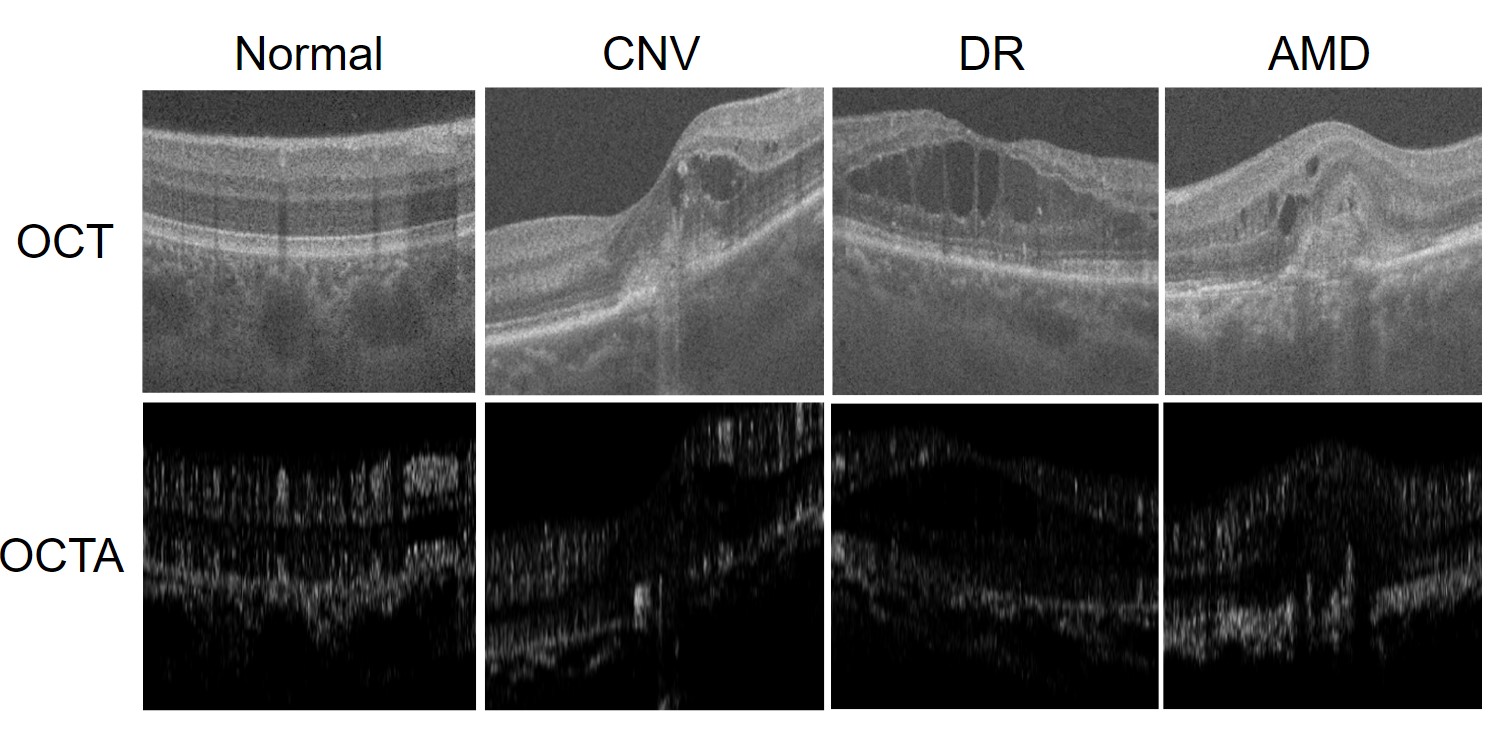 [2407.15293] Enhancing Retinal Disease Classification from OCTA Images via Active Learning ...