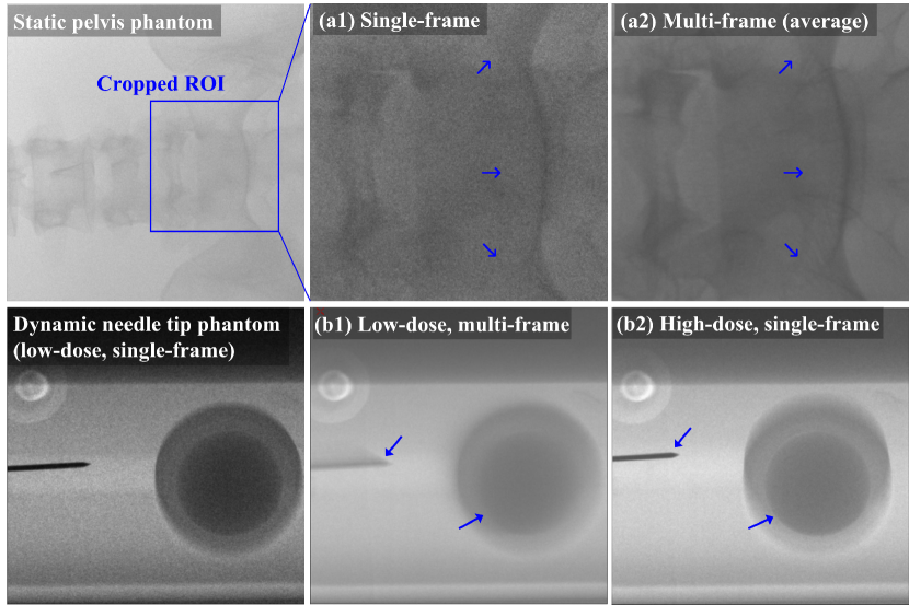 [2411.00830] Unsupervised Training of a Dynamic Context-Aware Deep Denoising Framework for Low ...