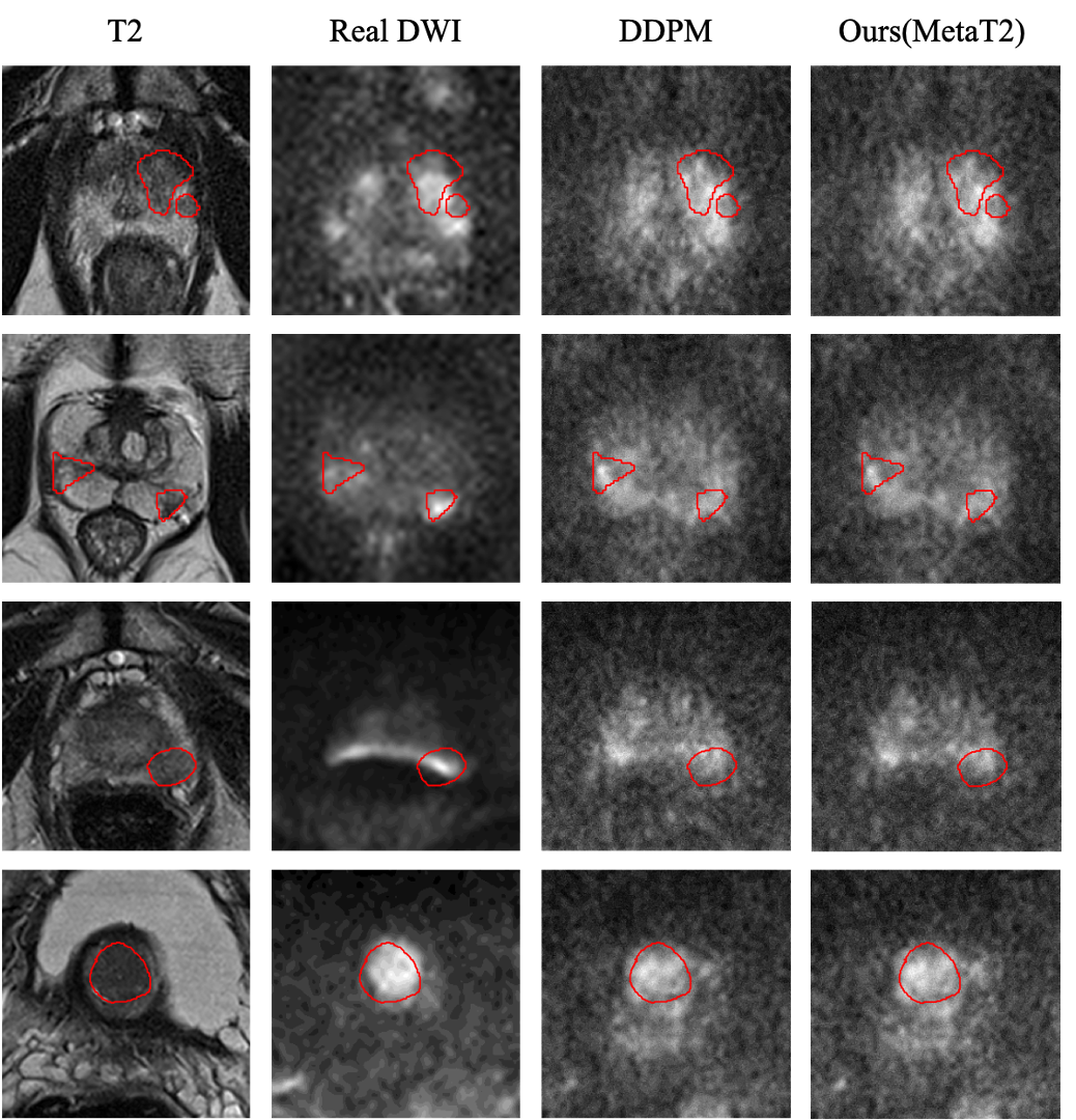 [2411.07416] T2-only prostate cancer prediction by meta-learning from ...