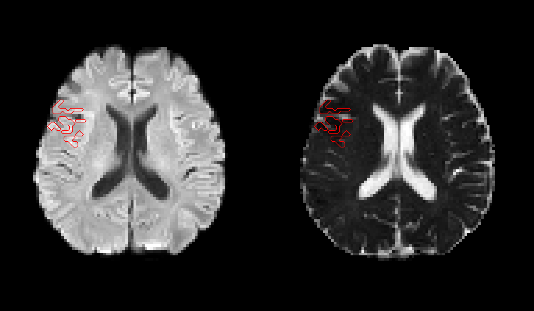 [2411.15490] Improving Factuality of 3D Brain MRI Report Generation ...