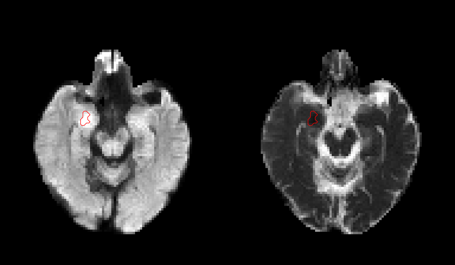 [2411.15490] Improving Factuality of 3D Brain MRI Report Generation ...