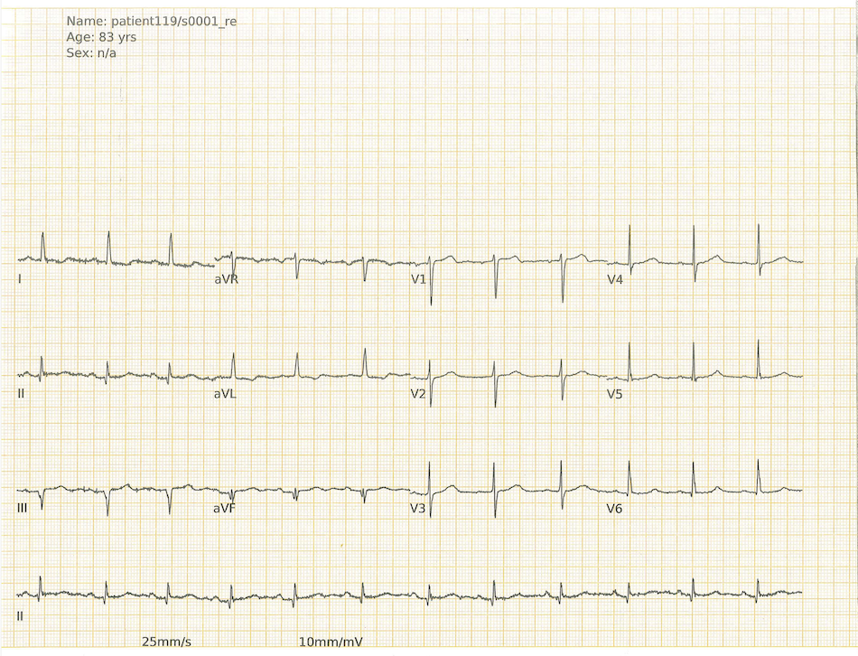 [2502.14909] PTB-Image: A Scanned Paper ECG Dataset for Digitization ...