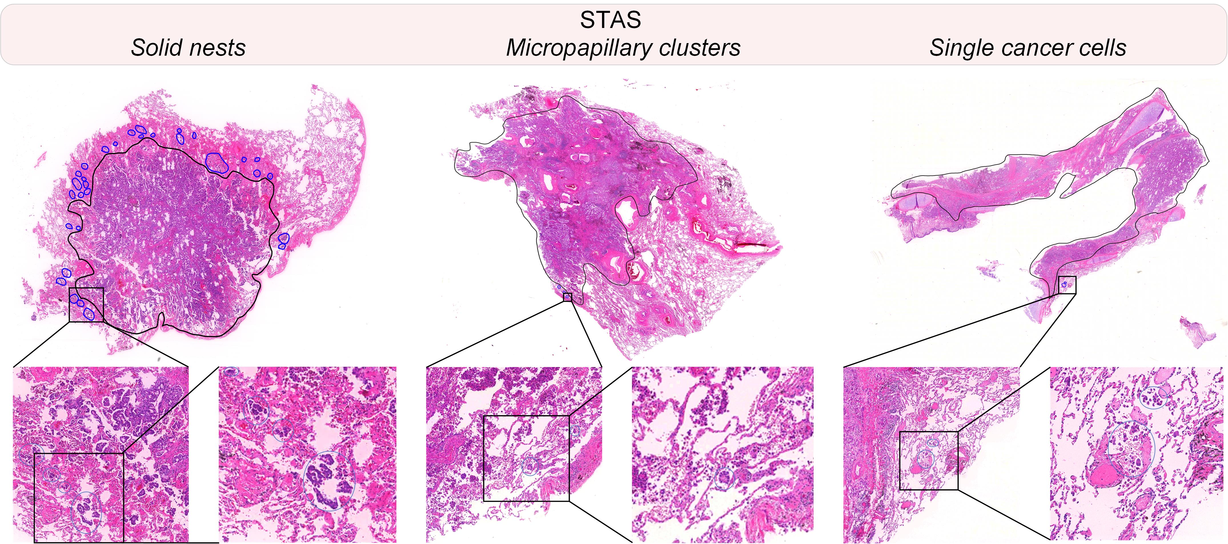 [2503.13799] SMILE: a Scale-aware Multiple Instance Learning Method for Multicenter STAS Lung ...