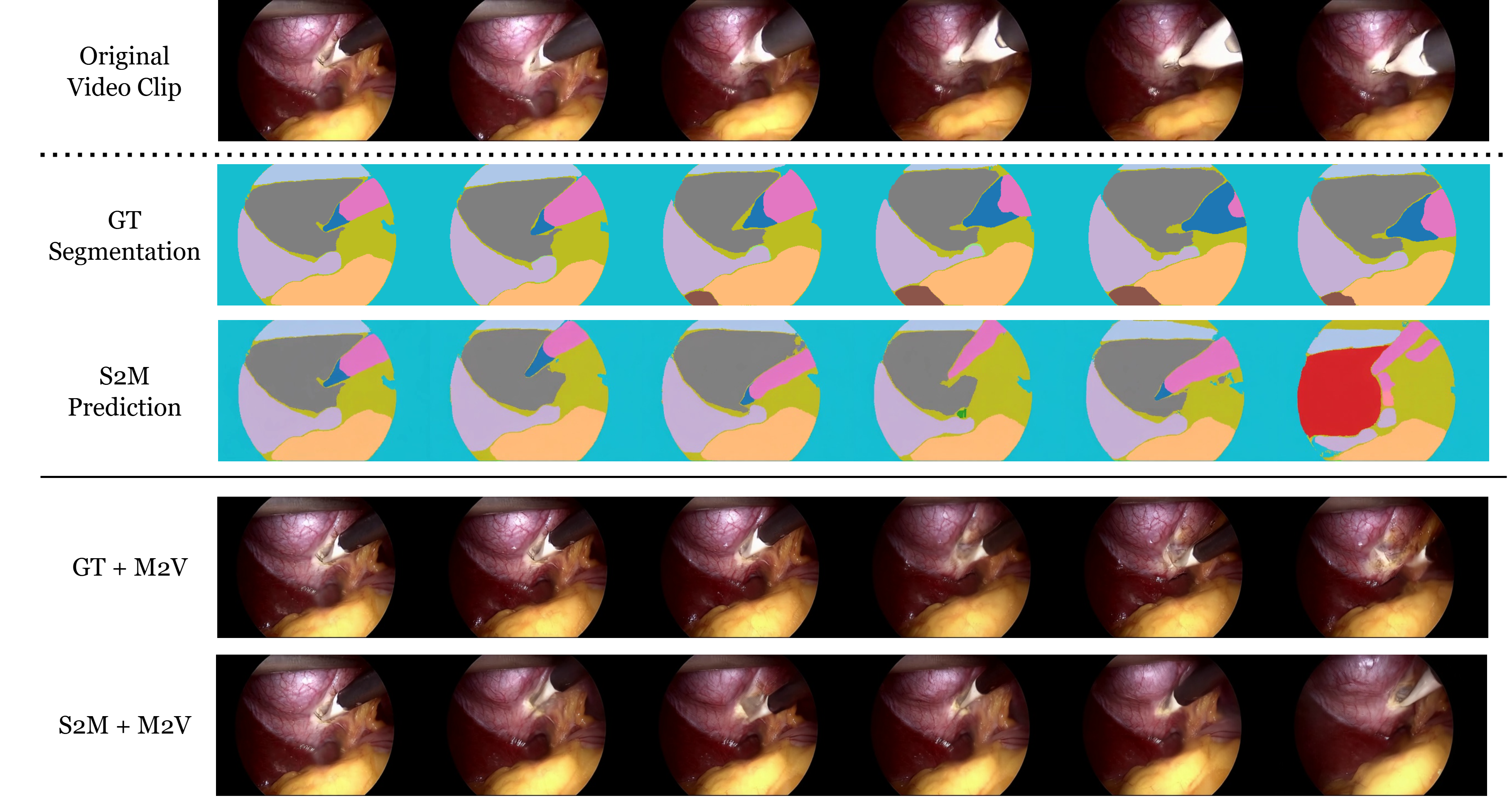[2506.21287] HieraSurg: Hierarchy-Aware Diffusion Model for Surgical ...
